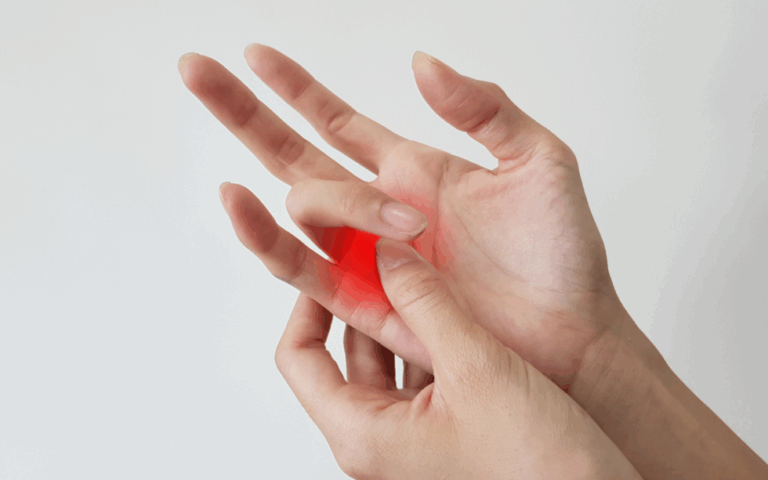 Trigger Finger Steroid Injection Guide